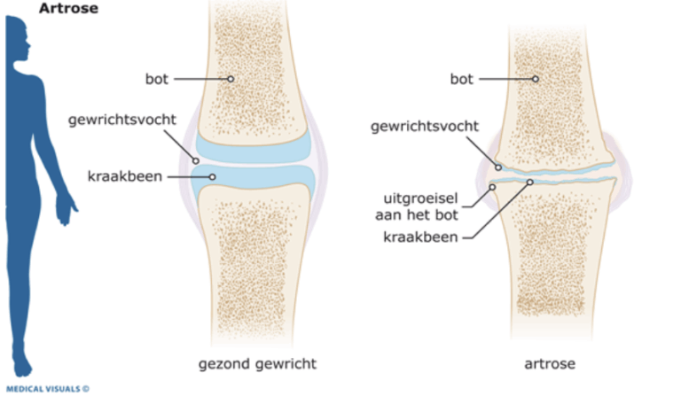 Artrose knie en heup - Fysio-Actief